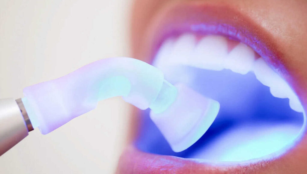 Teeth Whitening Turkey – Dental İmplanst Turkey